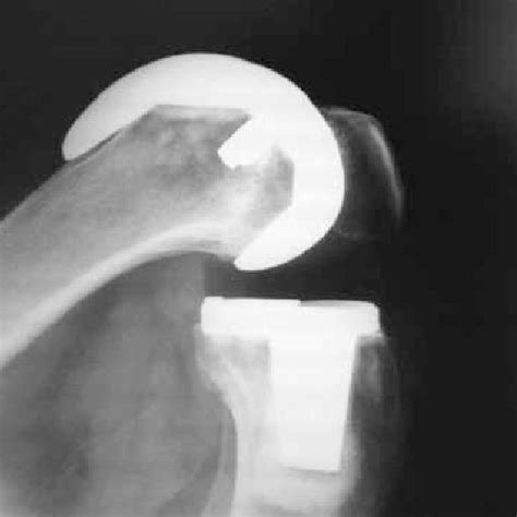 Posterior Subluxation Of Tibia On Stress View Download Scientific