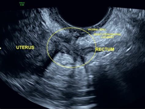 Can You Be Diagnosed With Endometriosis From An Ultrasound