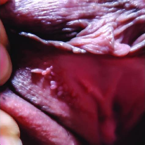 Multiple Pink Colored Translucent Digitate Papules Present On Inner
