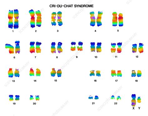 Cri Du Chat Syndrome Karyotype Stock Image C022 0575 Science