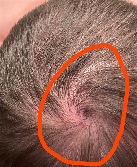 Second Opinion On Scalp Mark R DermatologyQuestions