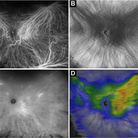 Multimodal Imaging Correlation Of Choroidal Vascular Hyperpermeability
