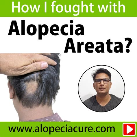 Alopecia Treatment Review Hair Loss Treatment Review