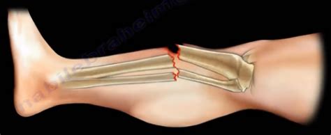 Dr Nabil Ebraheims Blogspot Open Fractures Of The Tibia