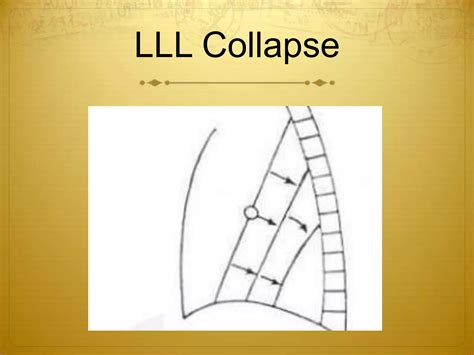Collapse And Consolidation Made Simple Chest X Rayz Pptx