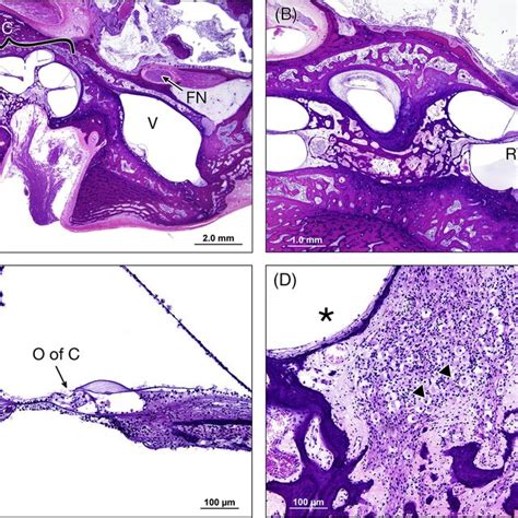 Cochlear Pathology In The Right Ear A Low Magnification Near