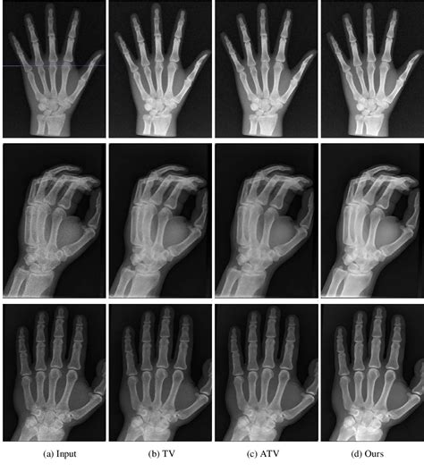 Figure 4 From Quantum Noise Removal In X Ray Images With Adaptive Total