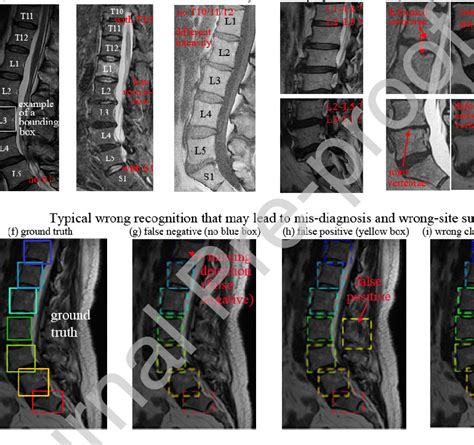 Challenges Of Automatic Vertebrae Recognition In Arbitrary Spine Images Download Scientific