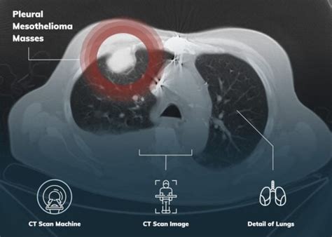 Reactive Mesothelial Cells Vs Mesothelioma Ihc