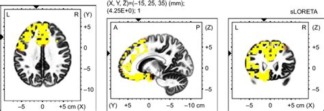 Voxel Wise Statistical Non Parametric Map Snpm Of Resting State