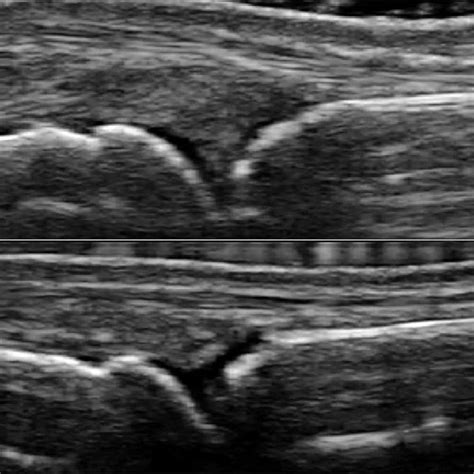 Synovitis In Ra Mcp Joints Visualised By High Field And Low Field Mri Download Scientific