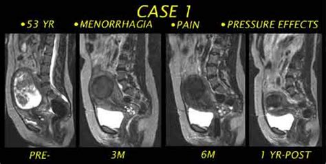 Brg Uterine Artery Embolization Uae Aka Uterine Fibroid