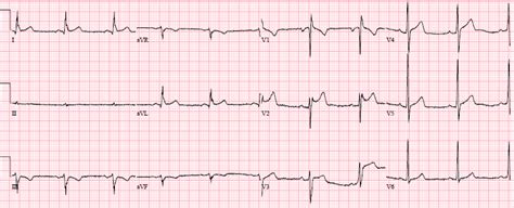 Dr Smith S Ecg Blog October 2010