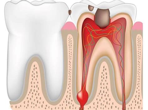 Что такое пульпит зуба? Как лечат хронический и острый пульпит
