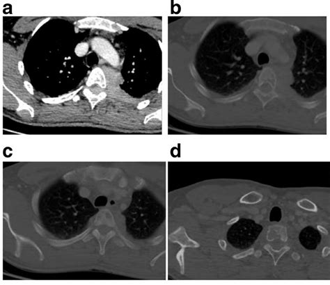 Ct Chest Withcontrast Soft Tissue Window Show Left Paraspinal Mass