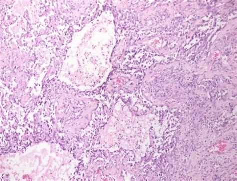 Poorly Differentiated Malignant Neoplasm With Spindle Cell And Download Scientific Diagram