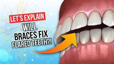 Can Braces Fix Flared Teeth Youtube