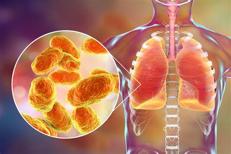 Bronchiectasis Symptoms Risk Factors And Treatment Options Lpt Medical