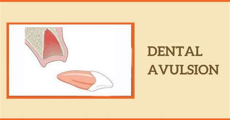Dental Avulsion Symptoms Causes Treatment