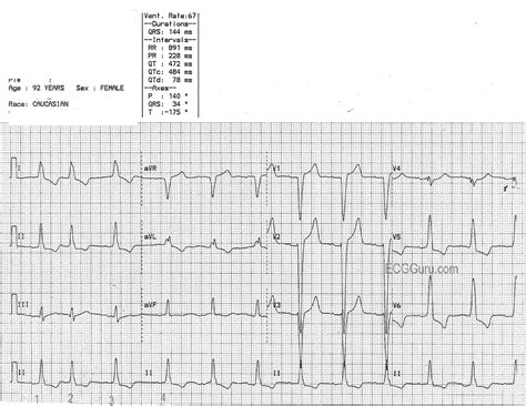 Left Bundle Branch Block Ecg Guru Instructor Resources