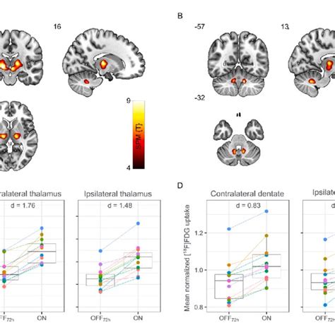 Results Of Whole Brain Voxel Wise Analysis Of Regional Cerebral Glucose