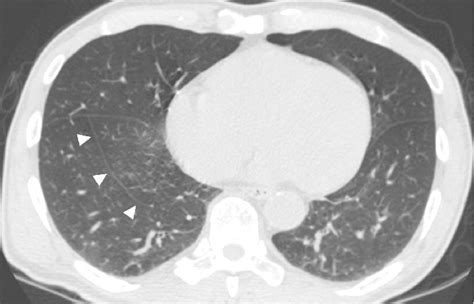 Inferior Accessory Fissure The Mdct Axial Image Shows A Right Inferior