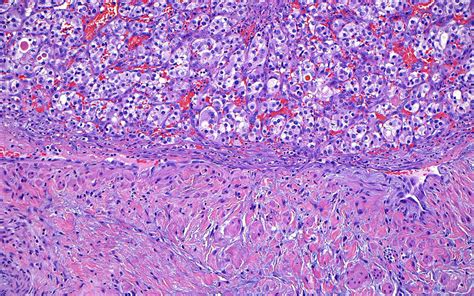 Renal Cell Cancer Tumour Thrombus Light Micrograph Stock Image