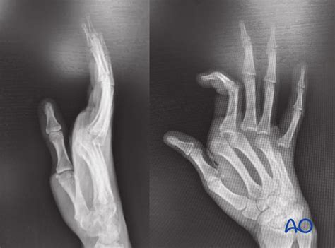 Dislocation Of The Metacarpophalangeal Joint