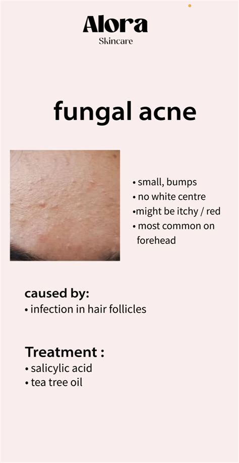 Best 13 K Beauty For Fungal Acne Skincare Guide Part 1 Artofit