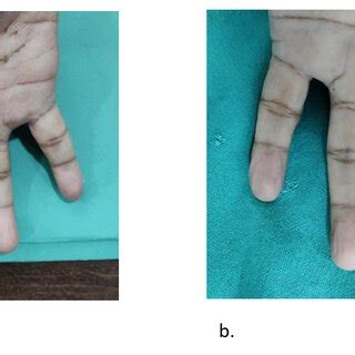 Pdf A Rare Confusing Presentation Carpal Tunnel Syndrome As First