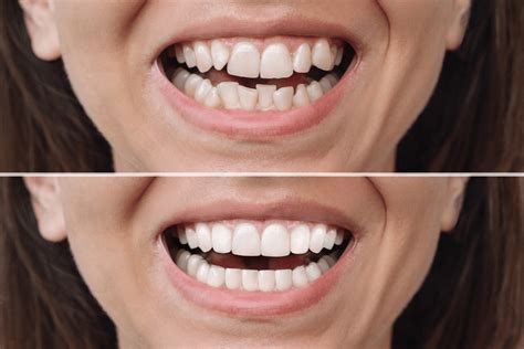 Dental Veneers Before And After Unveiling Your Dream Smile