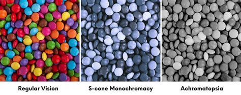 Monochromacy Achromatopsia And S Cone Monochromacy