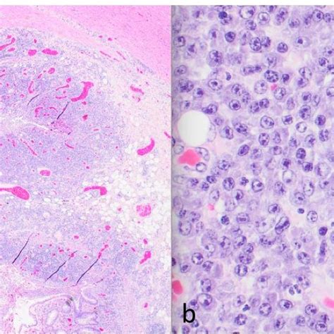 Plasmablastic Cells Are Uniformly Positive For Mum1 A And Demonstrate