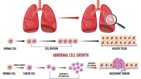 What Are The Symptoms Of Small Cell Lung Cancer