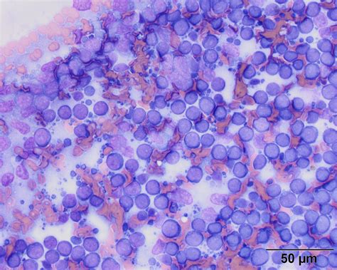 B Cell Archives Eclinpath