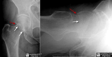 Normal Hip Xray Femoral Neck Fracture Xray Ctmens