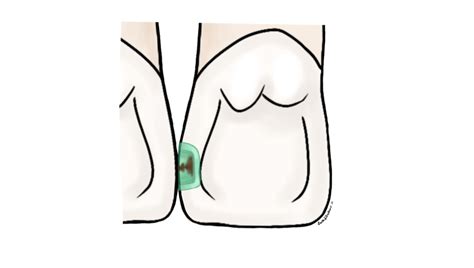 Class Iii Composite Preparation My Dental Key