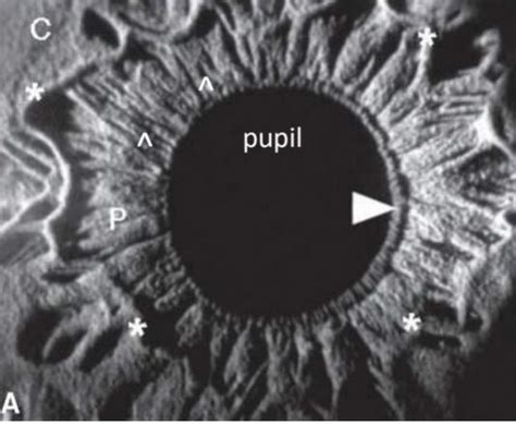 Uvea Iris Flashcards Quizlet