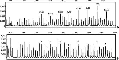 Duplication Of Exons 53 60 Of Dystrophin Gene In Patient 6 A Compared