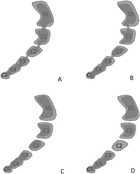 Coccygeoplasty Preliminary Experience With This New Alternative