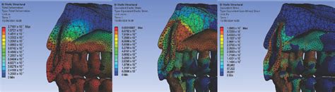 Figure 17 From Simulation Of An Orthodontic System Using The Lingual Technique Based On The
