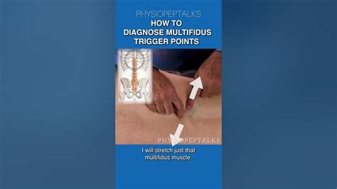 How To Diagnose Multifidus Trigger Points Multifidustriggerpoints