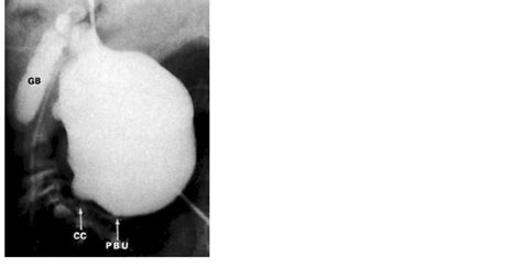 Intraoperative Cholangiogram Showing Cystic Dilatation Of The Common Download Scientific