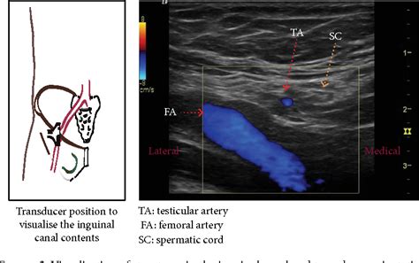 New Approach Of Ultrasoundguided Genitofemoral Nerve [pdf] Ultrasound