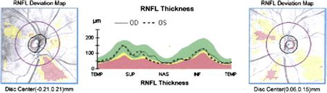 Retinal Nerve Fiber Layer Rnfl Thickness Map Represents The Thickness Download Scientific