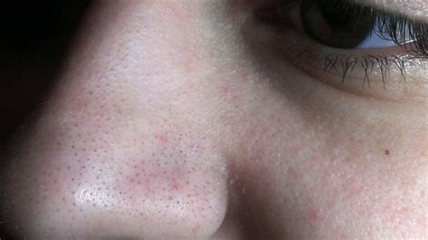 Как избавиться от черных точек на носу Youtube
