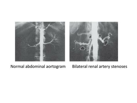 Ppt Aortorenal And Selective Renal Arteriography Powerpoint