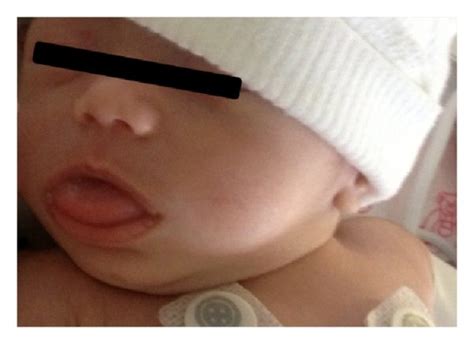 Tsga Neonate With Macroglossia Download Scientific Diagram