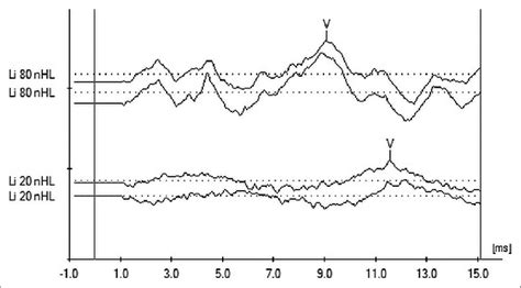 Auditory Brainstem Response Waveforms Evoked By 250 Hz Tone Burst For Download Scientific
