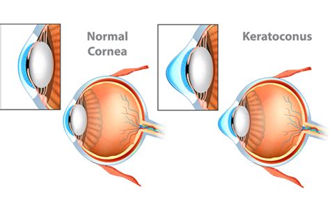 Cornea Specialists Seattle Cornea Diseases Seattle WA EANW